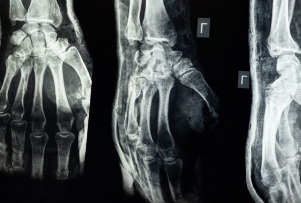 What Are the Benefits of Hand Grip Exercises? 7 Tips for Hand Grip ...